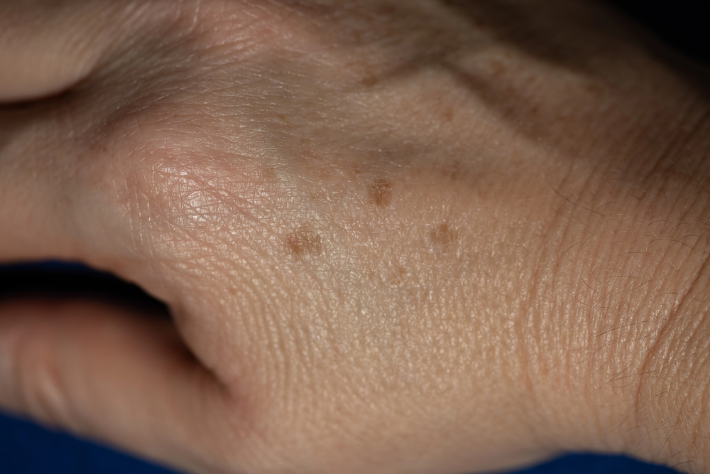 What is Hyperpigmentation and What Can You Do About It? – Momtastic ...