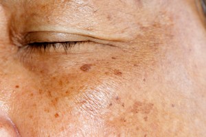 What is Hyperpigmentation and What Can You Do About It? – Momtastic ...